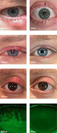 Dry Eye Solutions - Premier Eye Center
